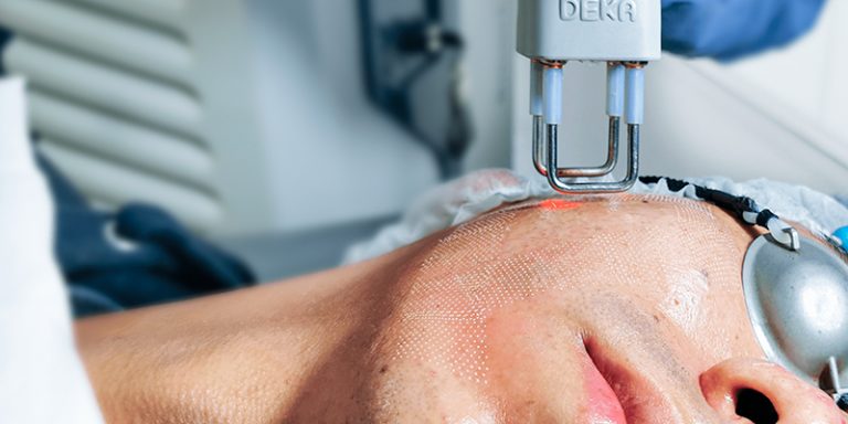 Láser De Co2 Fraccionado Para La Cara ⭐ Cliniderma Bogotá Colombia